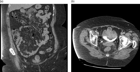 Bladder Neoplasm Abdominal Key