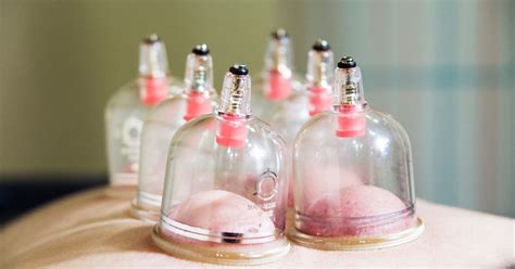 부항도 의료행위 간호조무사에 부항 치료시킨 한의사 벌금형