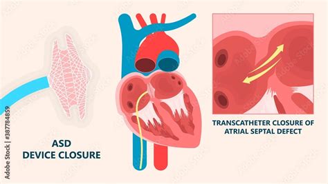 Cath Lab Atrial Septal Defect Tetralogy Of Fallot Patent Foramen Ovale Mitral Valve Stenosis