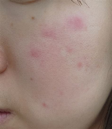 도와주세요ㅠㅠ 피부 붉은반점 지식in