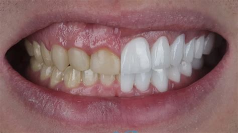 Maxillary Central Incisors Definition Anatomy And Common Procedures