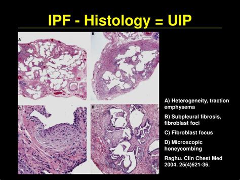 Ppt Hamlets Delight New Guidelines For Ipf Powerpoint Presentation