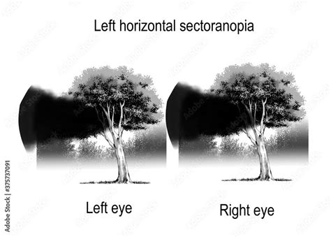 Patterns Of Visual Field Defects Are Sign And Symtomp Of Loss Of Vision Which Are Derived From