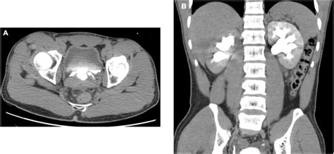 Idiopathic Bilateral Ureteral Stenosis Presenting As Bilateral