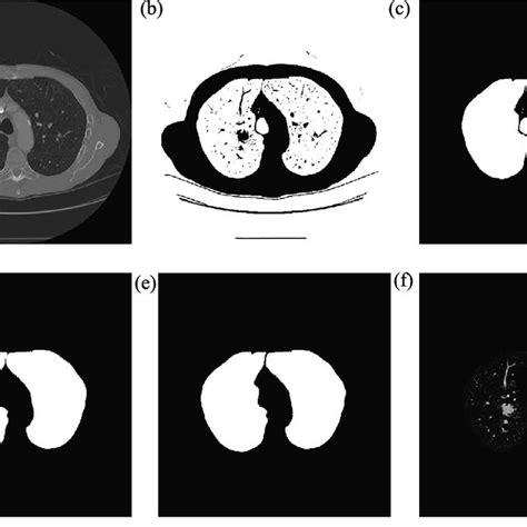Pdf Automatic Lung Segmentation For The Inclusion Of Juxtapleural