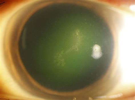 Disciform Endotheliitis