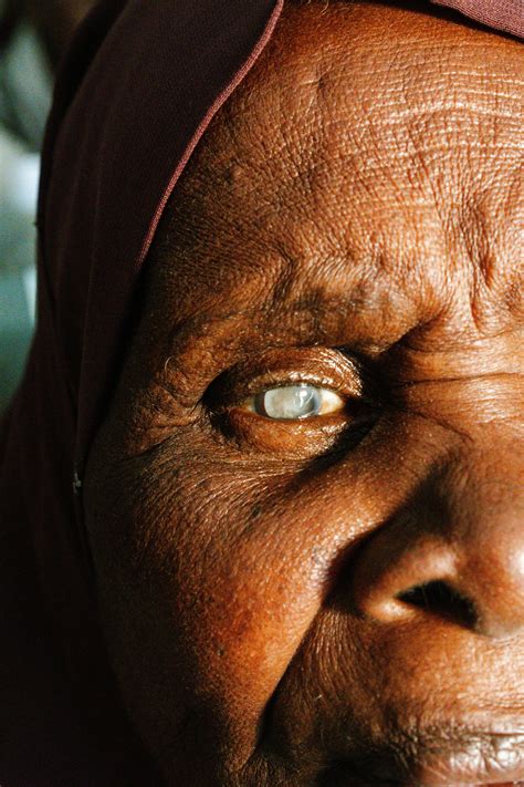 Understanding Cataracts Symptoms Causes And Treatment Options