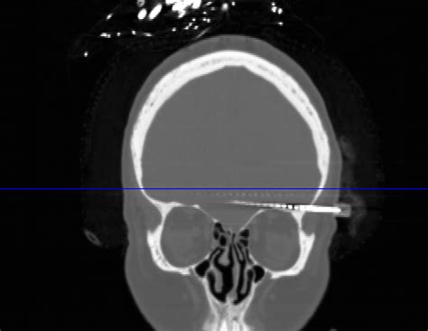 Electrode Detection Instance Segmentation Model By Nevermore
