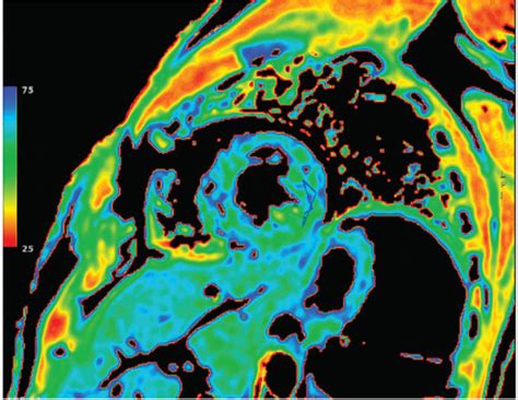 A Rare Case Of Coccidioidal Myopericarditis Jacc