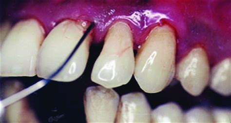 Application Of Doxycycline Hyclate Gel Download Scientific Diagram