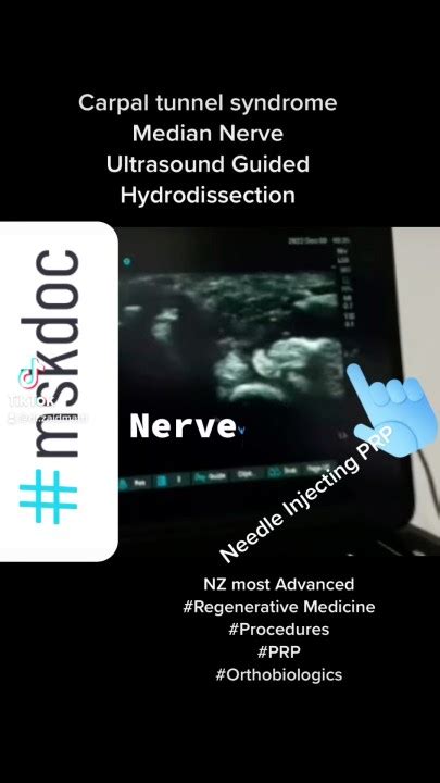Zaid Matti On Linkedin Ultrasound Guided Median Nerve Hydrodissection