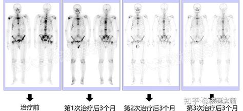 让骨转移患者从此摆脱疼痛困扰，“骨转移肿瘤的克星”——氯化锶 知乎