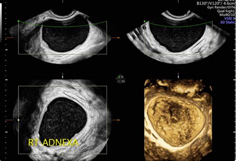 Case Of The Month August 2022 Incidental Right Adnexal Mass Wfumb