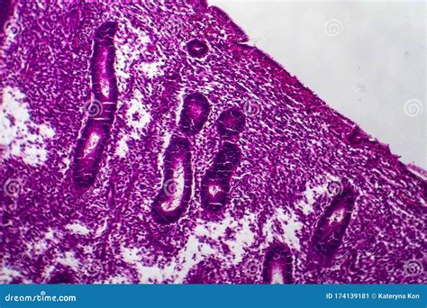 Endometrial Hyperplasia Light Micrograph Stock Image Image Of Hematoxylin Morphology 174139181
