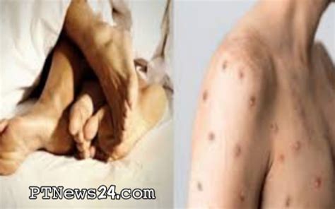Is Monkeypox Really an STD Experts कय कहत ह Symtoms Prevention