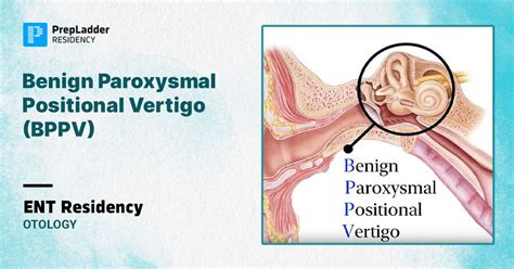 Benign Paroxysmal Positional Vertigo Bppv