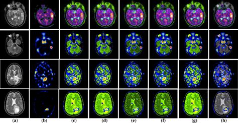 spect mri fusion results of cases 2 to 5 a mri images b spect images
