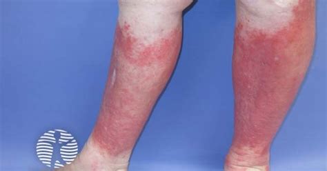 Acute Lipodermatosclerosis Image