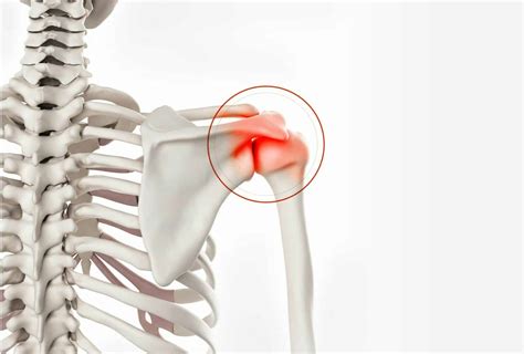 Shoulder Acromioplasty Doctor Philippe Paillard Office