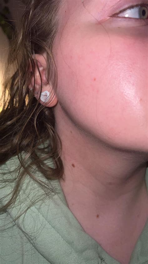 3 Week Progress On Doxycycline Hyclate 100mg And Ketoconazole 2 R Acne