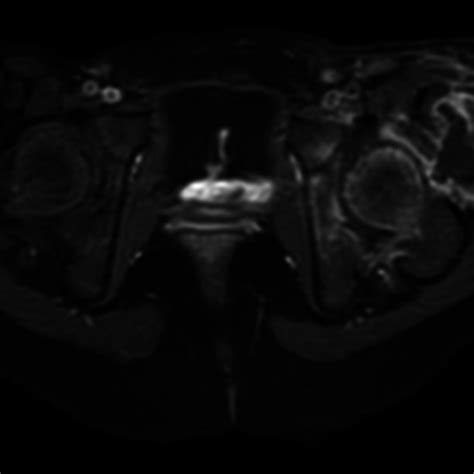 Mri Axial T1 Fat Suppression Sequence After Iv Gadolinium Showing