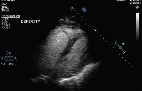 PERT Development And Implementation To Standardize Patient Pathway For Pulmonary Embolism