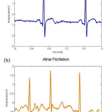 Pdf Computer Aided Diagnosis Of Atrial Fibrillation Based On Ecg Signals A Review
