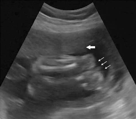 Breech Presentation Ultrasound