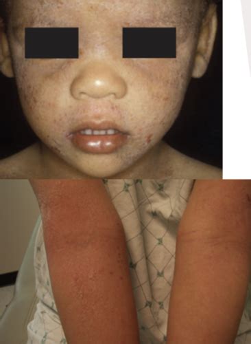 Derm Part Flashcards Quizlet