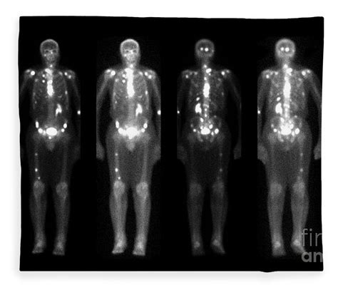 Nuclear Medicine Bone Scan