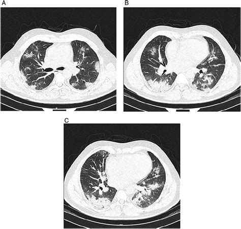 Chest Computed Tomography Scan Performed On Day 3 Of Admission When
