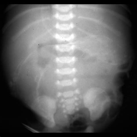 Newborn With A Distended Abdomen Pediatric Radiology Case Pediatric