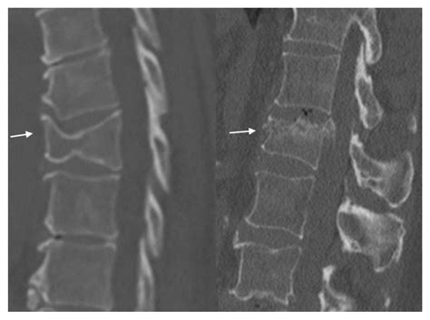 Radiological Diagnosis And Advances In Imaging Of Vertebral Compression