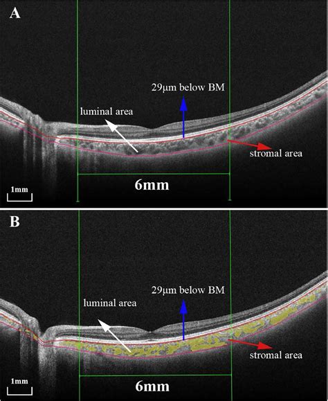 Choroidal Indicators For Pediatric Myopia Identified By Uwf Full Range Ss Octa Towardpi