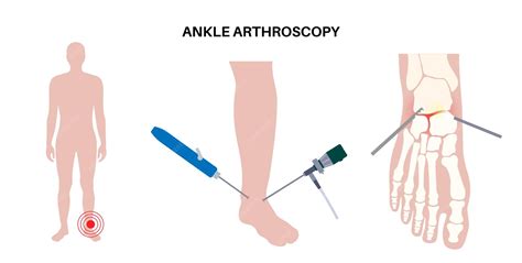 Premium Vector Ankle Arthroscopy Poster