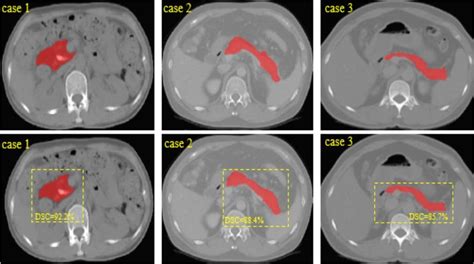 Pancreas Segmentation Results On Three Examples Of The Fmu Dataset