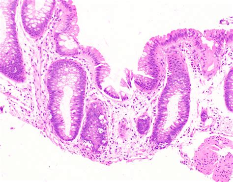 Pathology Outlines Mycophenolate Mofetil Associated Colitis