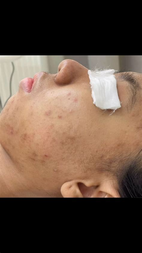 오산피부관리 뷰온 오산여드름피부 전문점 피부의 노화는 20대 중반부터 서서히 시작됩니다 보통 노화라고 하면 주름부터 먼저 생각하시게 되는데 얼굴 주름은 대부분 안면