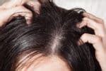 How To Get Rid Of Scalp Buildup Effective Ways
