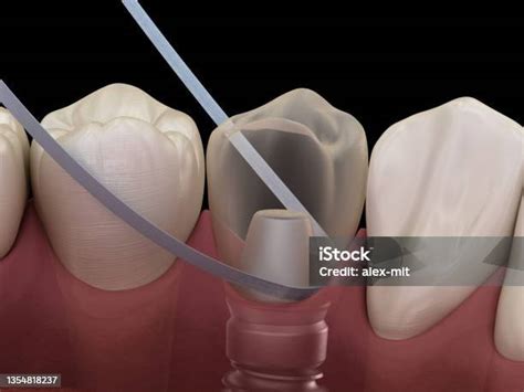 치과 치실로 치아 청소를 임플란트 의학적으로 정확한 3d 일러스트레이션 치아 임플란트에 대한 스톡 사진 및 기타 이미지 치아 임플란트 실패 임플란트 Istock
