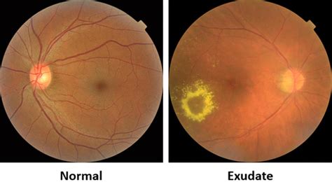 Enhancing Diabetic Retinopathy Diagnosis A Lightweight Cnn Architecture For Efficient Exudate