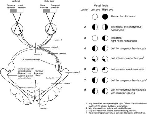 Lesions Of Visual Pathway Anatomia Neurologia Hemianopia