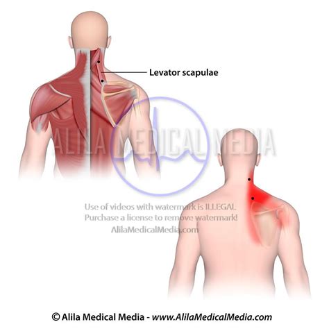 Levator Scapulae Trigger Points