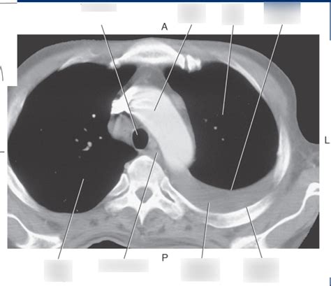 Pleural Effusion Ct Scan Diagram Quizlet