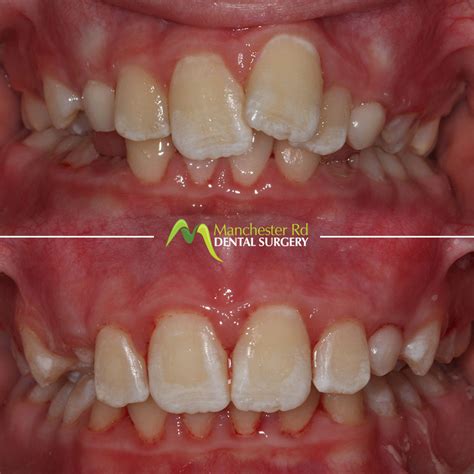 Early Intervention Orthodontics Manchester Rd Dental