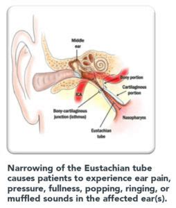 Eustachian Tube Dysfunction Gillum