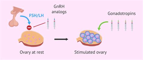 Ovarian Hyperstimulation Syndrome Wikem