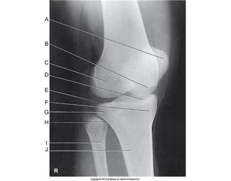 Oblique Knee X Ray Labeled At Dorothy Lim Blog