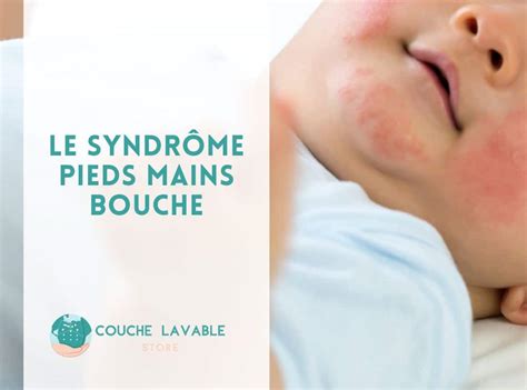 Quels Gestes Sont Conseillés En Cas De Syndrome Mains Pieds