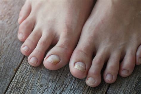 How To Fix Cracked Toe Nail Tardy Wellink